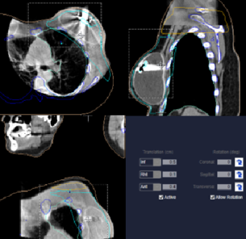 Overview: Breast – Localization & Treatment Procedures in Radiation Therapy
